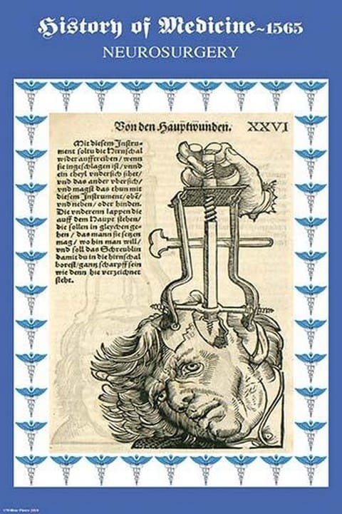 Neurosurgery by Paracelsus - Art Posters or Prints on Paper or Canvas ...